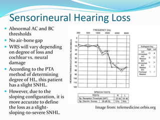 Conductive Vs Sensorineural Hearing Loss Audiogram