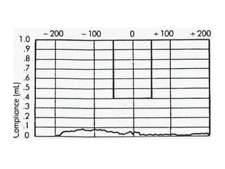 Audiogram & Tympanogram | PPT