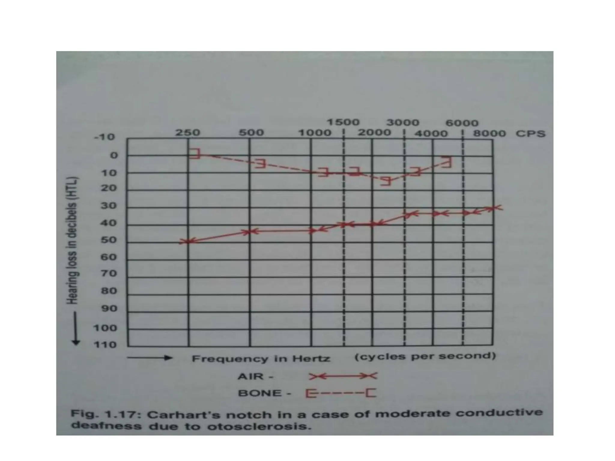 Audiological tests of hearing assessment | PPTX