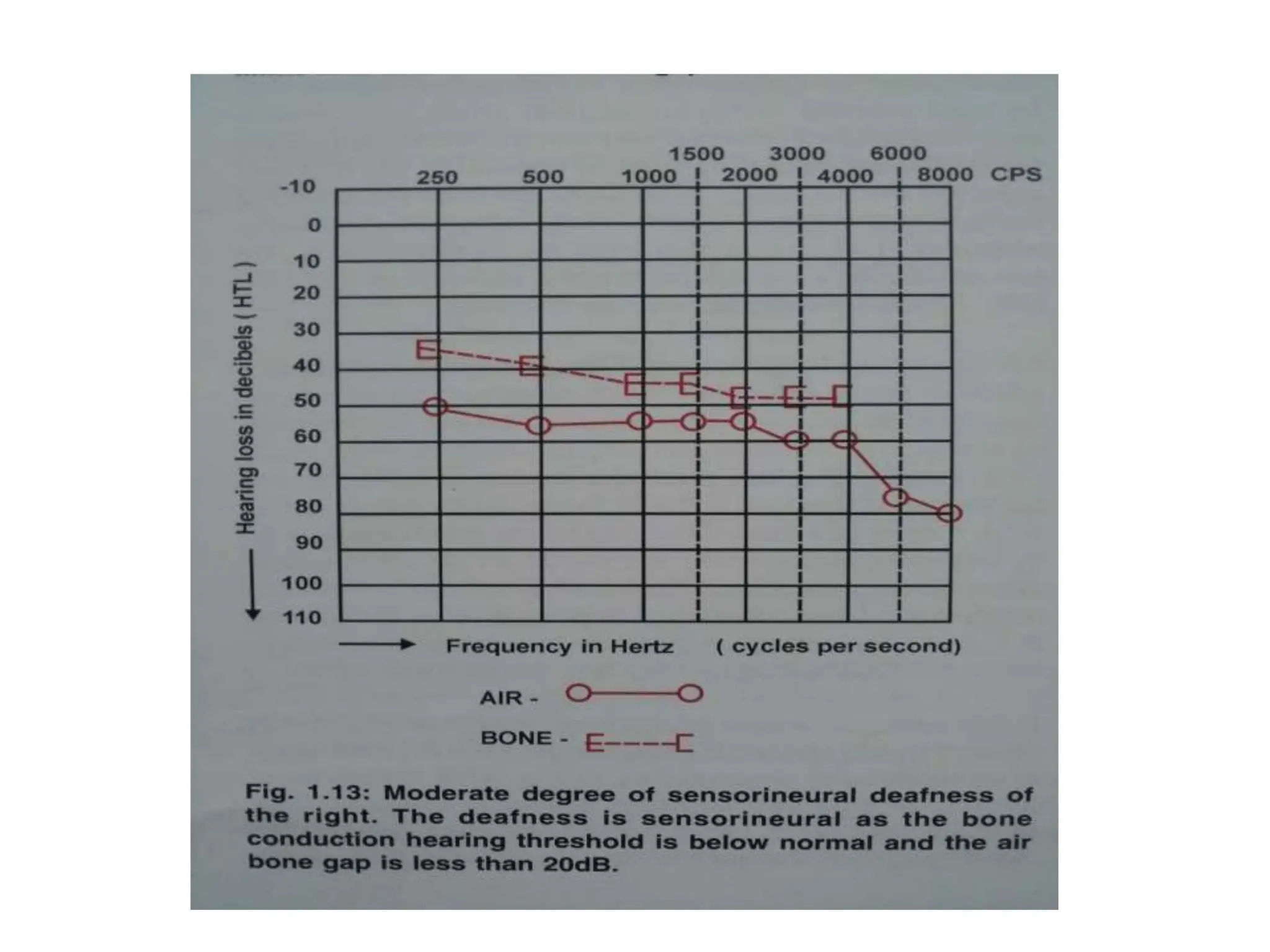 Audiological tests of hearing assessment | PPTX