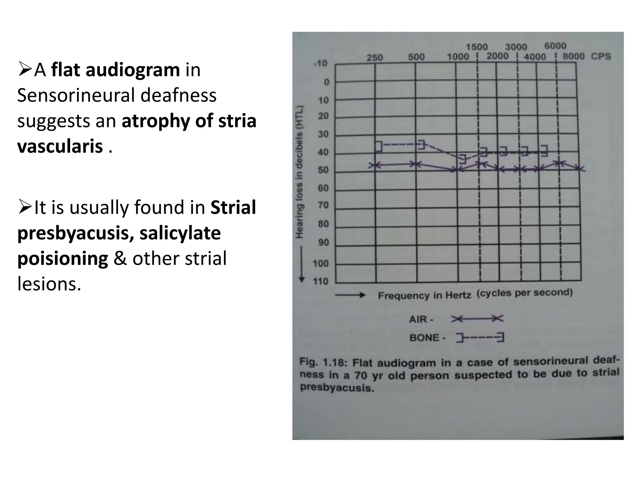 Audiological tests of hearing assessment | PPTX