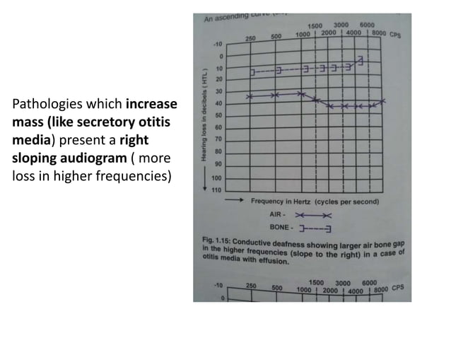 Audiological tests of hearing assessment | PPTX