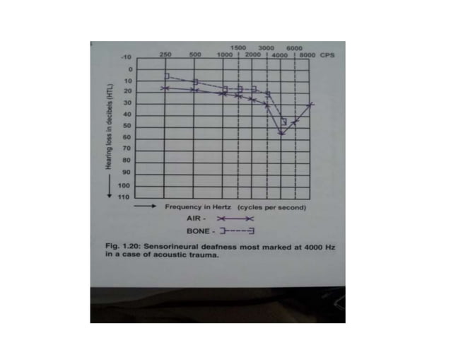 Audiological tests of hearing assessment | PPTX