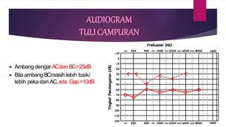 AUDIOMETRI, dr. Shanti Puji Lestari, Sp.Ok.pptx