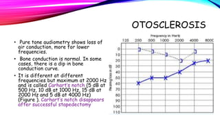 Otosclerosis Audiogram Carhart Notch