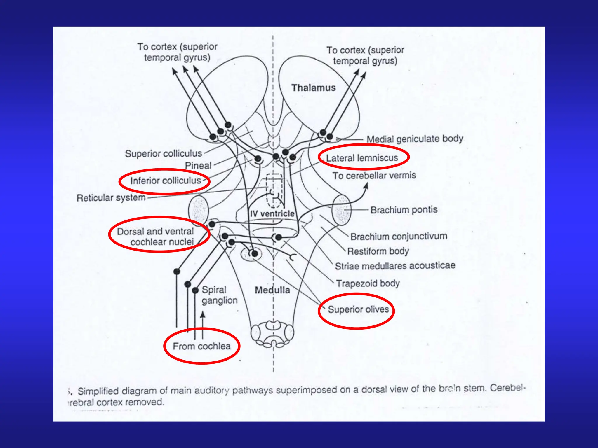 AUDITORY BRAINSTEM EVOKED RESPONSE (ABR).ppt