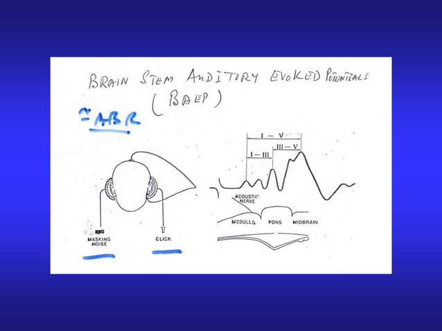 AUDITORY BRAINSTEM EVOKED RESPONSE (ABR).ppt