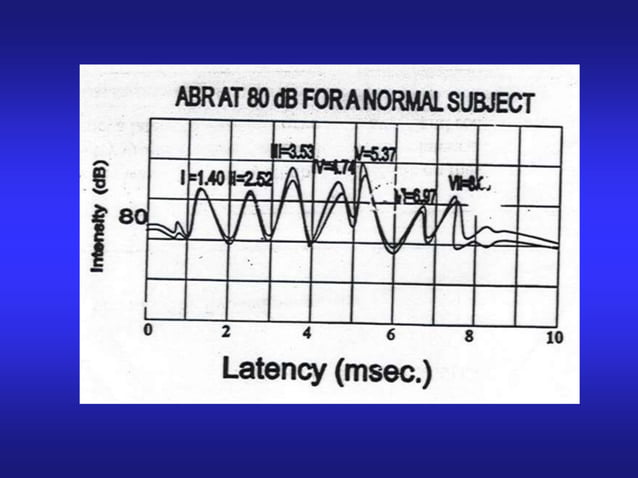 AUDITORY BRAINSTEM EVOKED RESPONSE (ABR).ppt