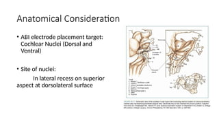 Auditory Brainstem Implant Presentations | PPTX