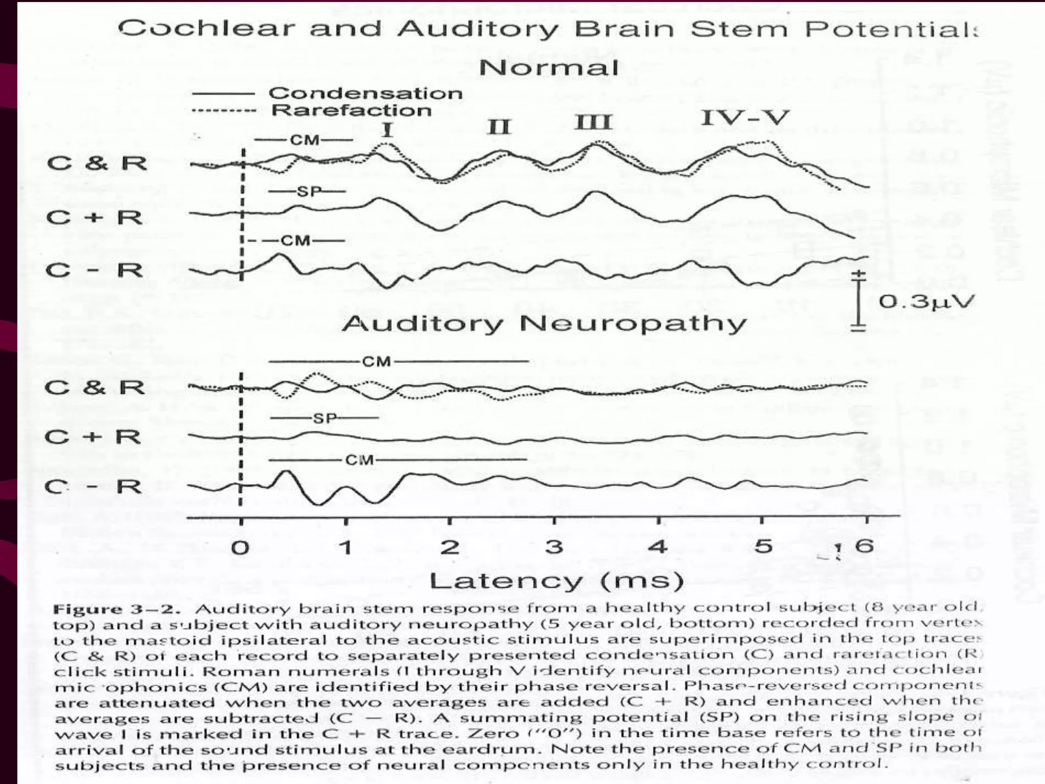 Auditory neuropathy | PPTX