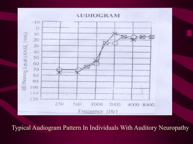 Auditory neuropathy | PPTX