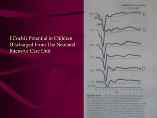 Auditory neuropathy | PPTX