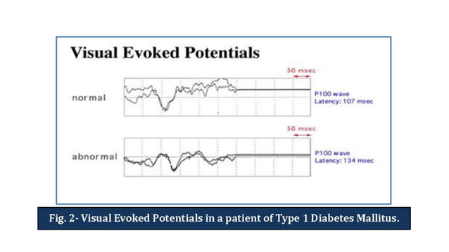 AUDITORY VISUAL EVOKED POTENTIAL.pptx | Eye and Vision Conditions | Diseases and Conditions