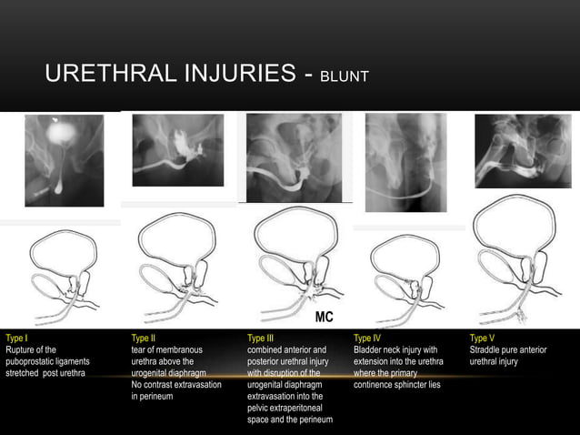 ascending urethrogram | PPTX