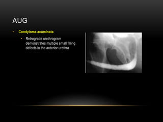 ascending urethrogram | PPTX