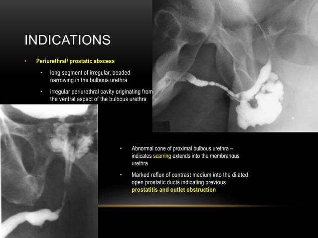 ascending urethrogram | PPTX