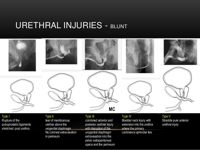ascending urethrogram