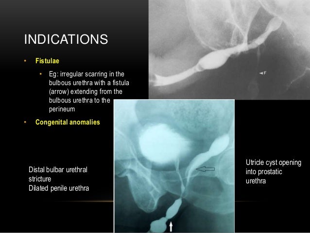 ascending urethrogram