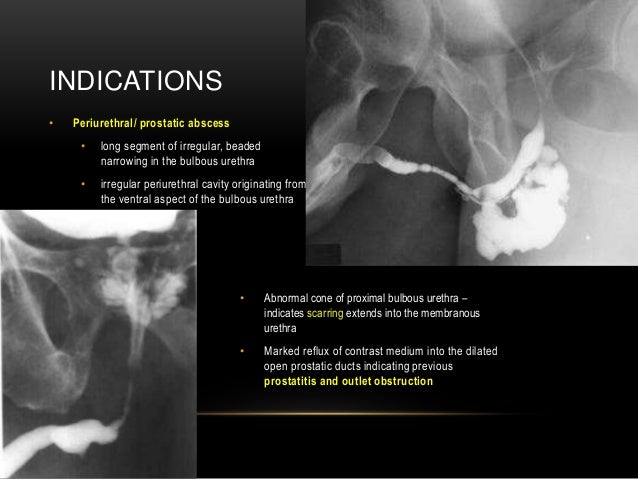 ascending urethrogram