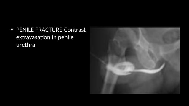 Anterior urethrogram,RETROGRADE URETHROGRAM.pptx