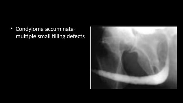 Anterior urethrogram,RETROGRADE URETHROGRAM.pptx