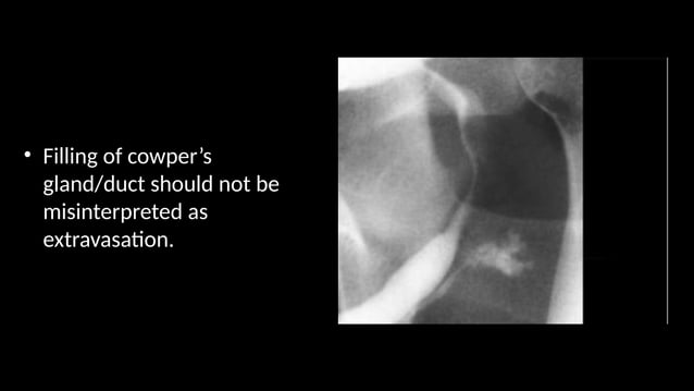 Anterior urethrogram,RETROGRADE URETHROGRAM.pptx