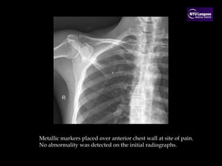 August 2013: NYU MSK Ultrasound case of the month | PPTX