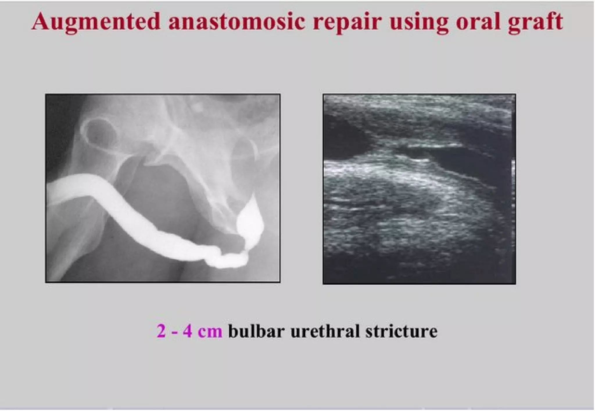 Augmented anastomotic repair sing dorsal oral mucosal graft | PDF