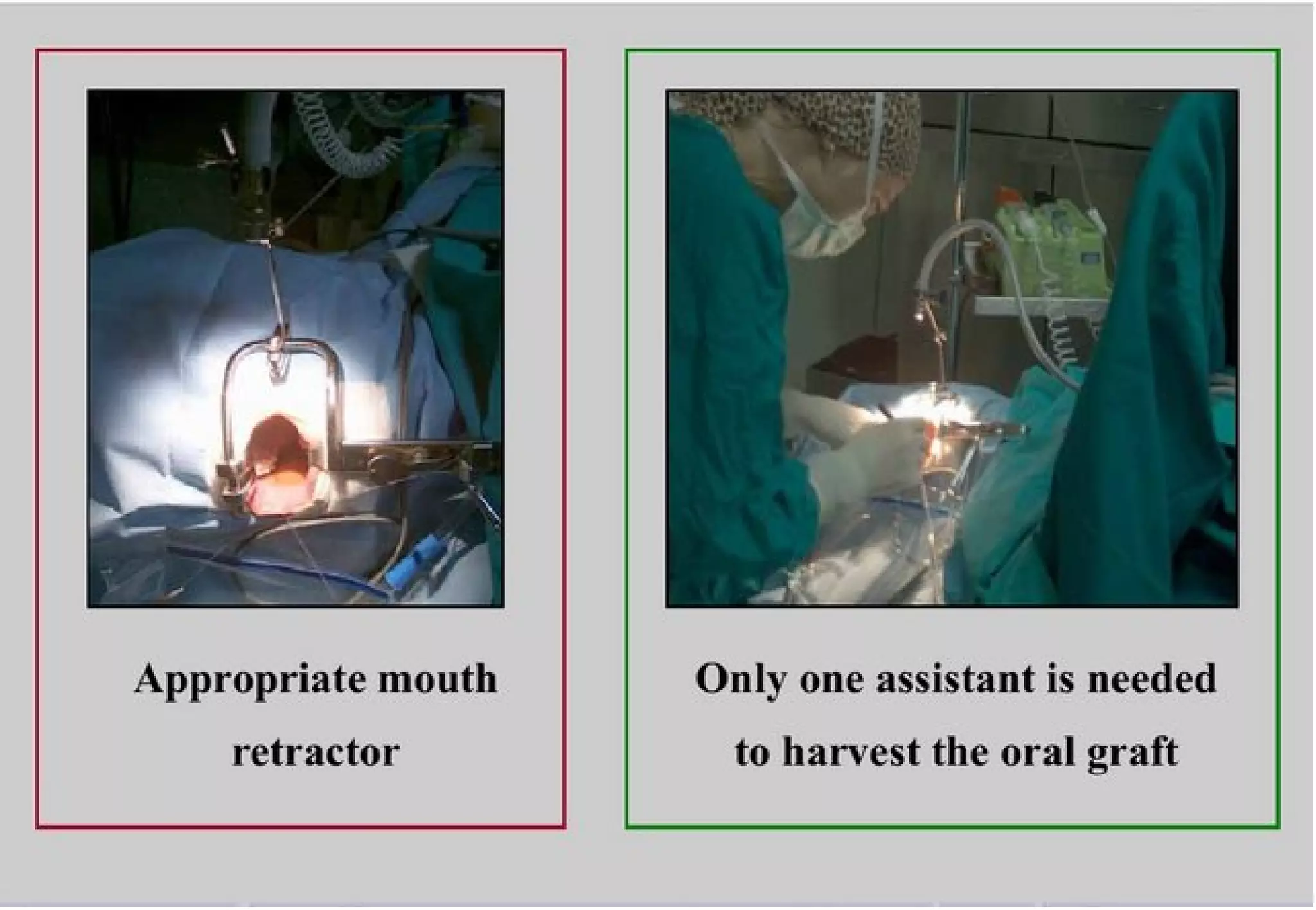 Augmented anastomotic repair sing dorsal oral mucosal graft | PDF
