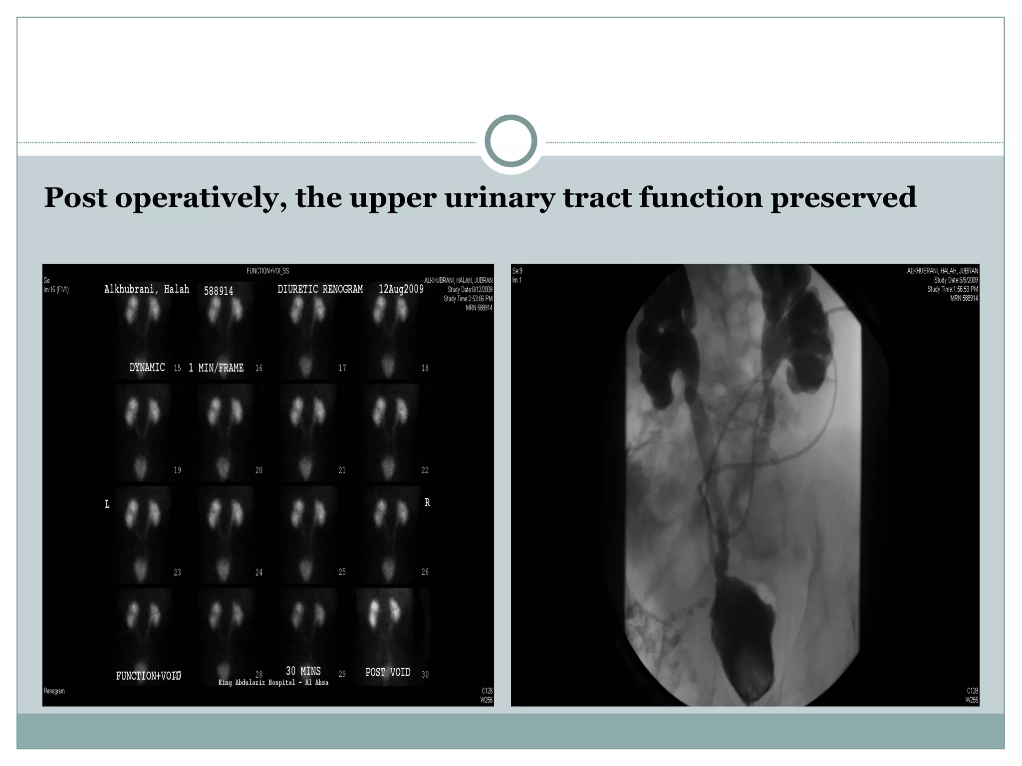 combined Monti-Ghonaim technique as urinary stoma | PPT