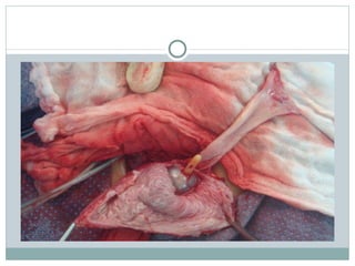 combined Monti-Ghonaim technique as urinary stoma | PPT