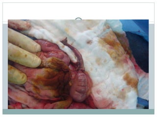 combined Monti-Ghonaim technique as urinary stoma | PPT