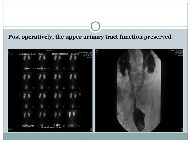 combined Monti-Ghonaim technique as urinary stoma | PPT | Free Download