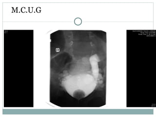 combined Monti-Ghonaim technique as urinary stoma | PPT | Free Download
