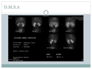 combined Monti-Ghonaim technique as urinary stoma | PPT