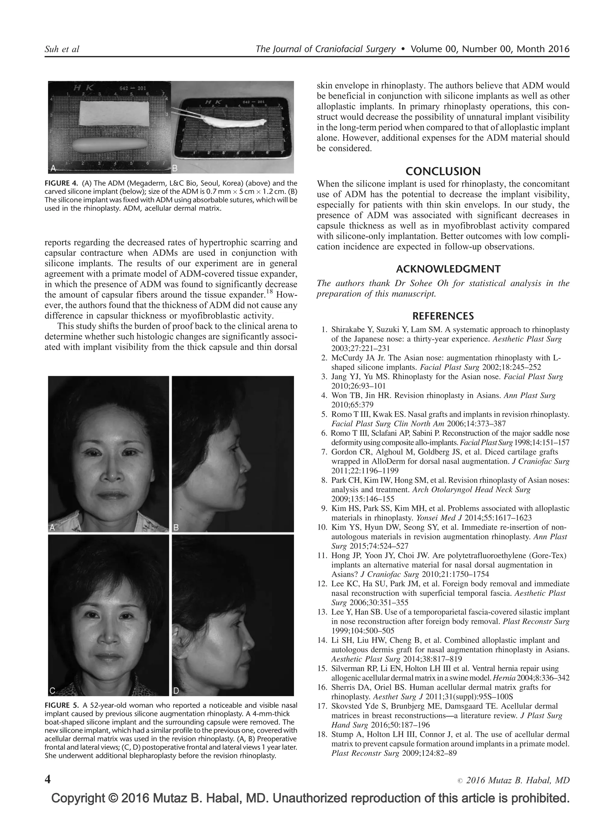 Augmentation rhinoplasty with silicone implant covered with acellular ...