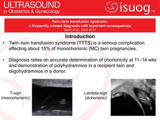 UOG Journal Club: Twin–twin transfusion syndrome: a frequently missed ...