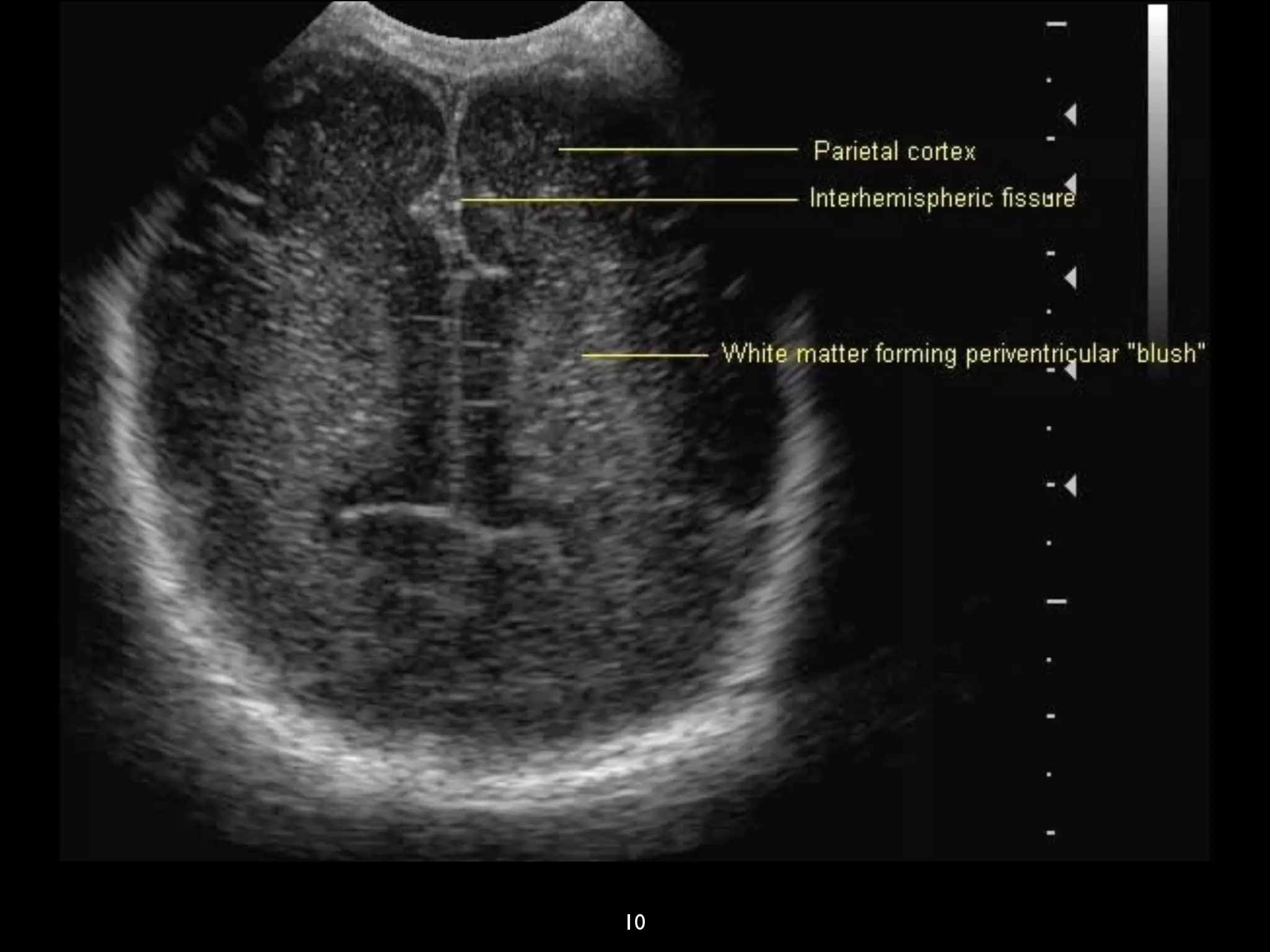 Neonatal Cranial & Spinal Ultrasound | PDF