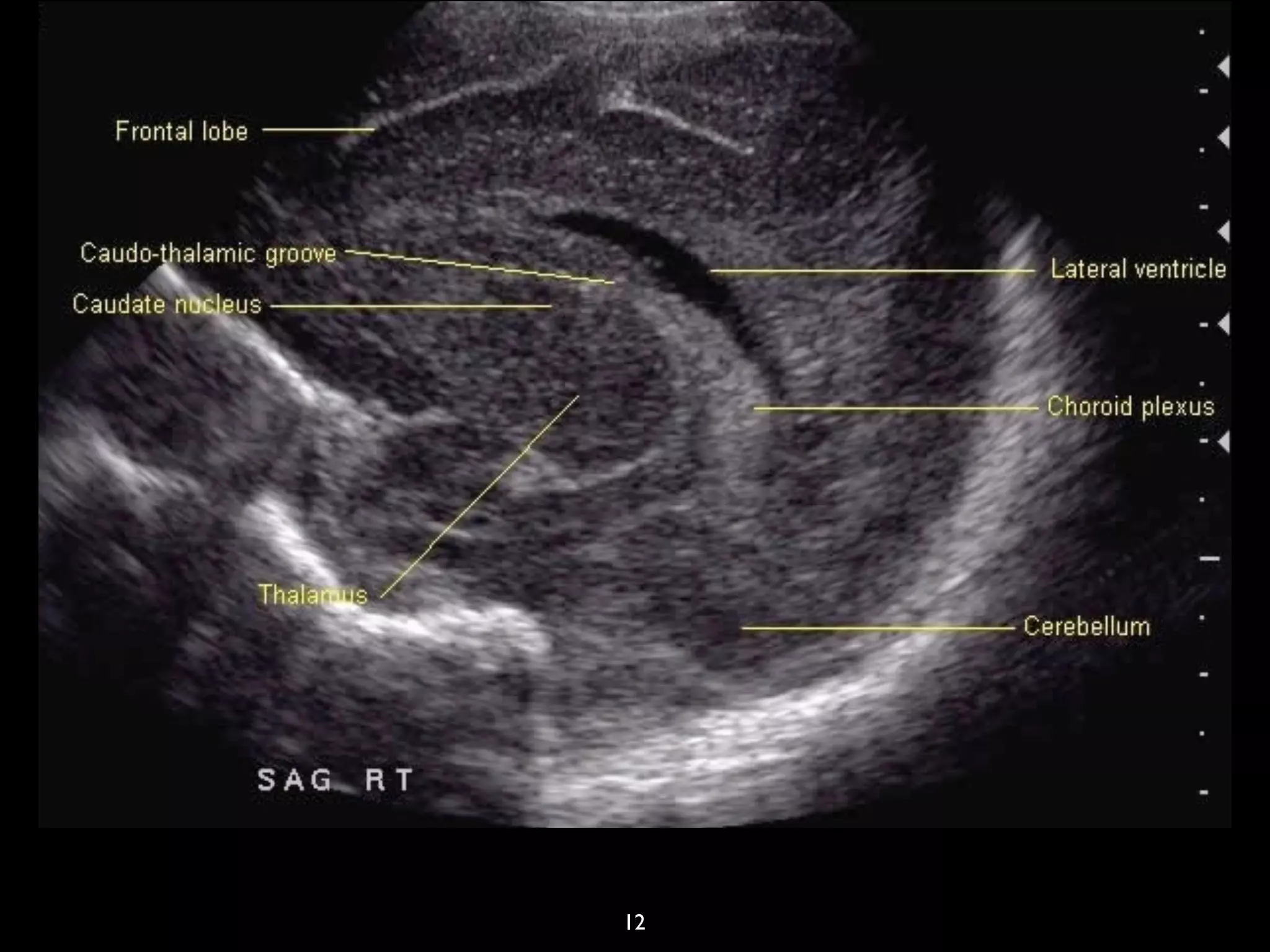 Neonatal Cranial & Spinal Ultrasound | PDF | Brain and Nervous System ...
