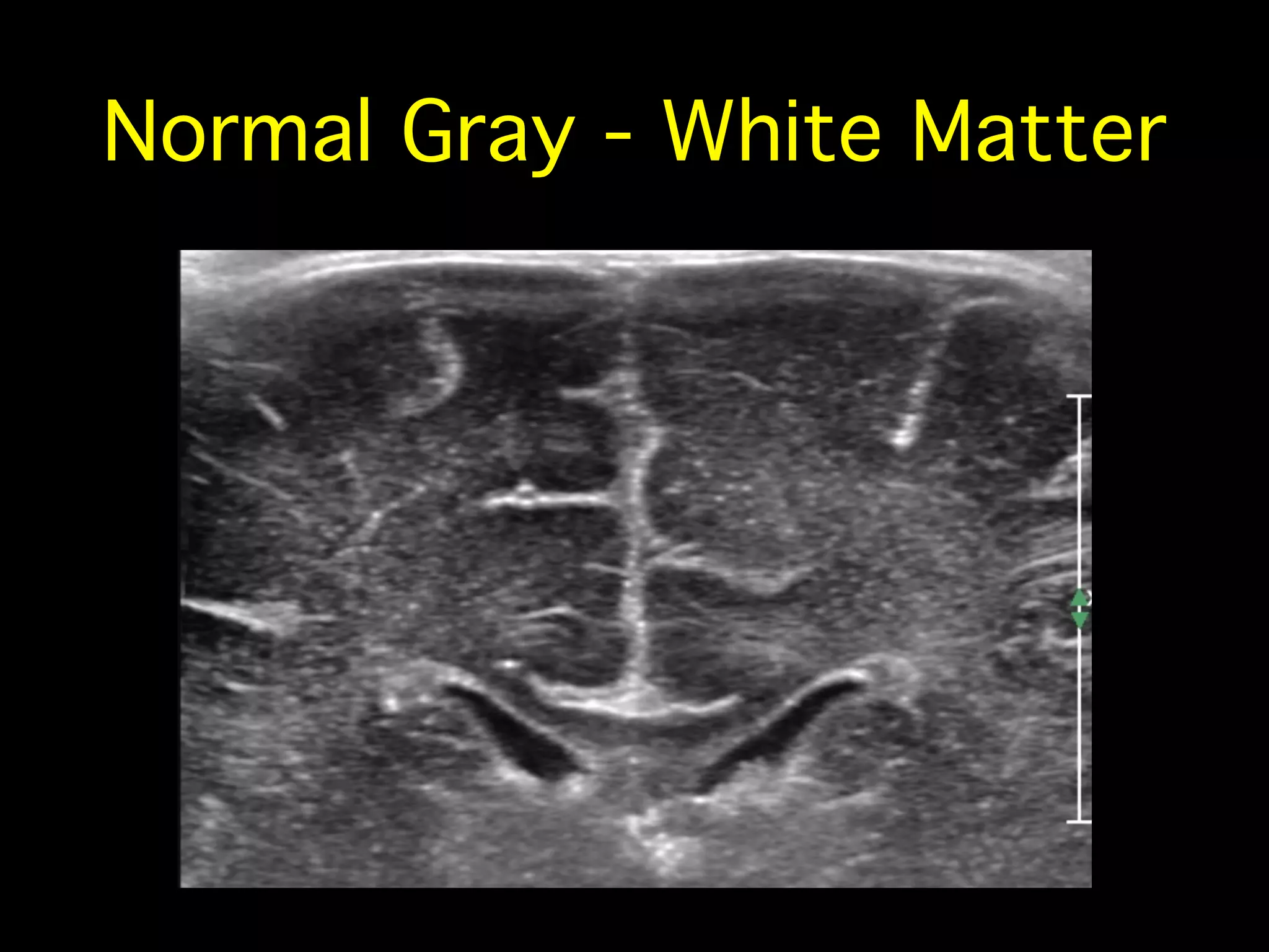 Neonatal Cranial & Spinal Ultrasound | PDF