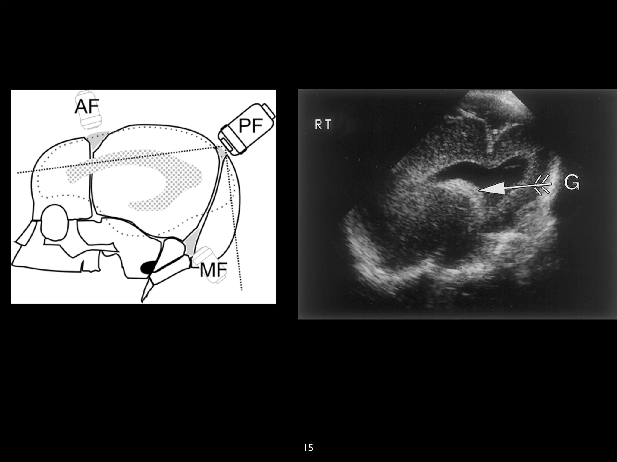 Neonatal Cranial & Spinal Ultrasound | PDF