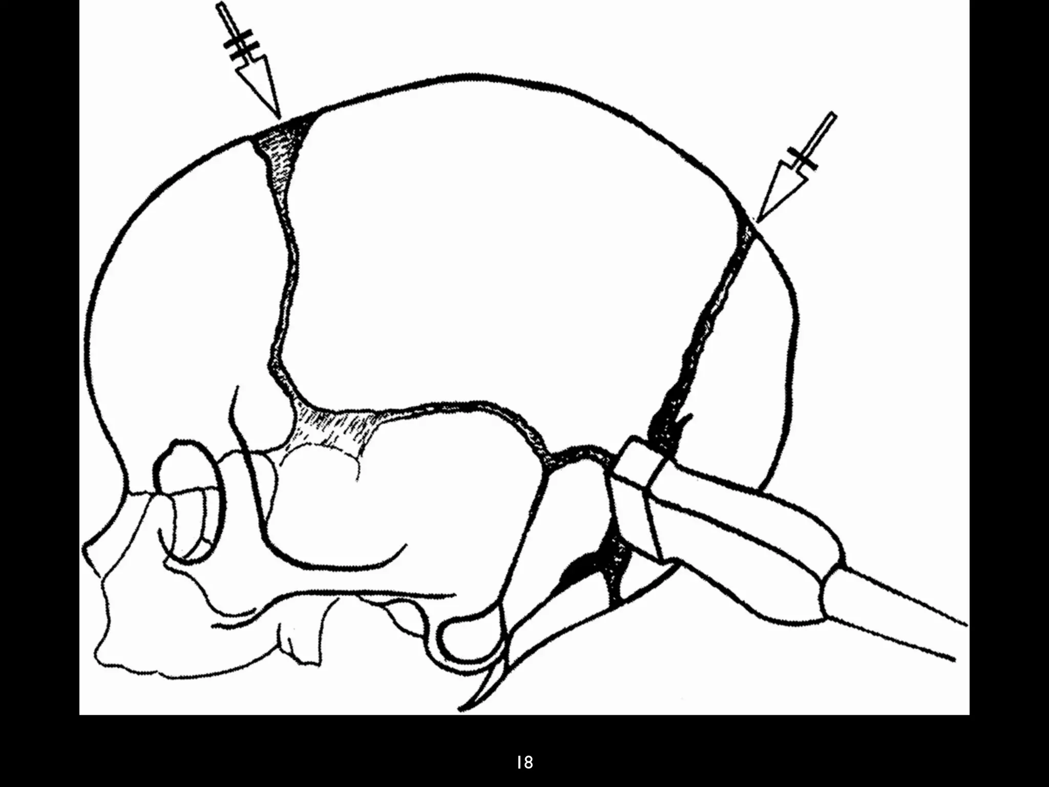 Neonatal Cranial & Spinal Ultrasound | PDF