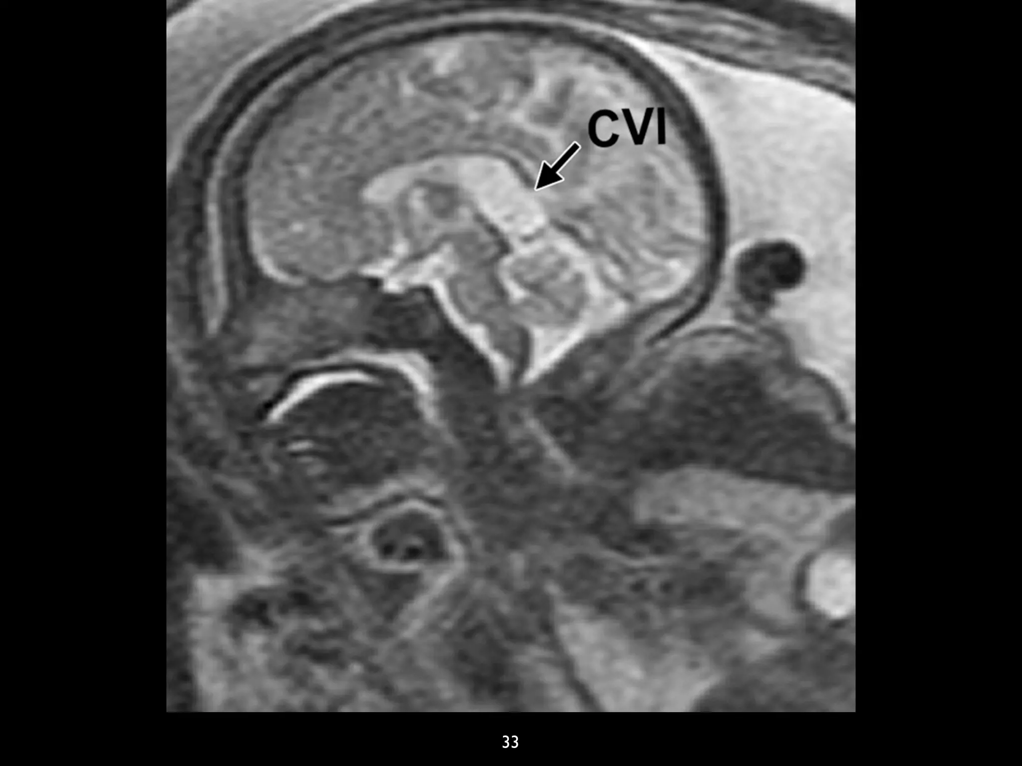 Neonatal Cranial & Spinal Ultrasound | PDF