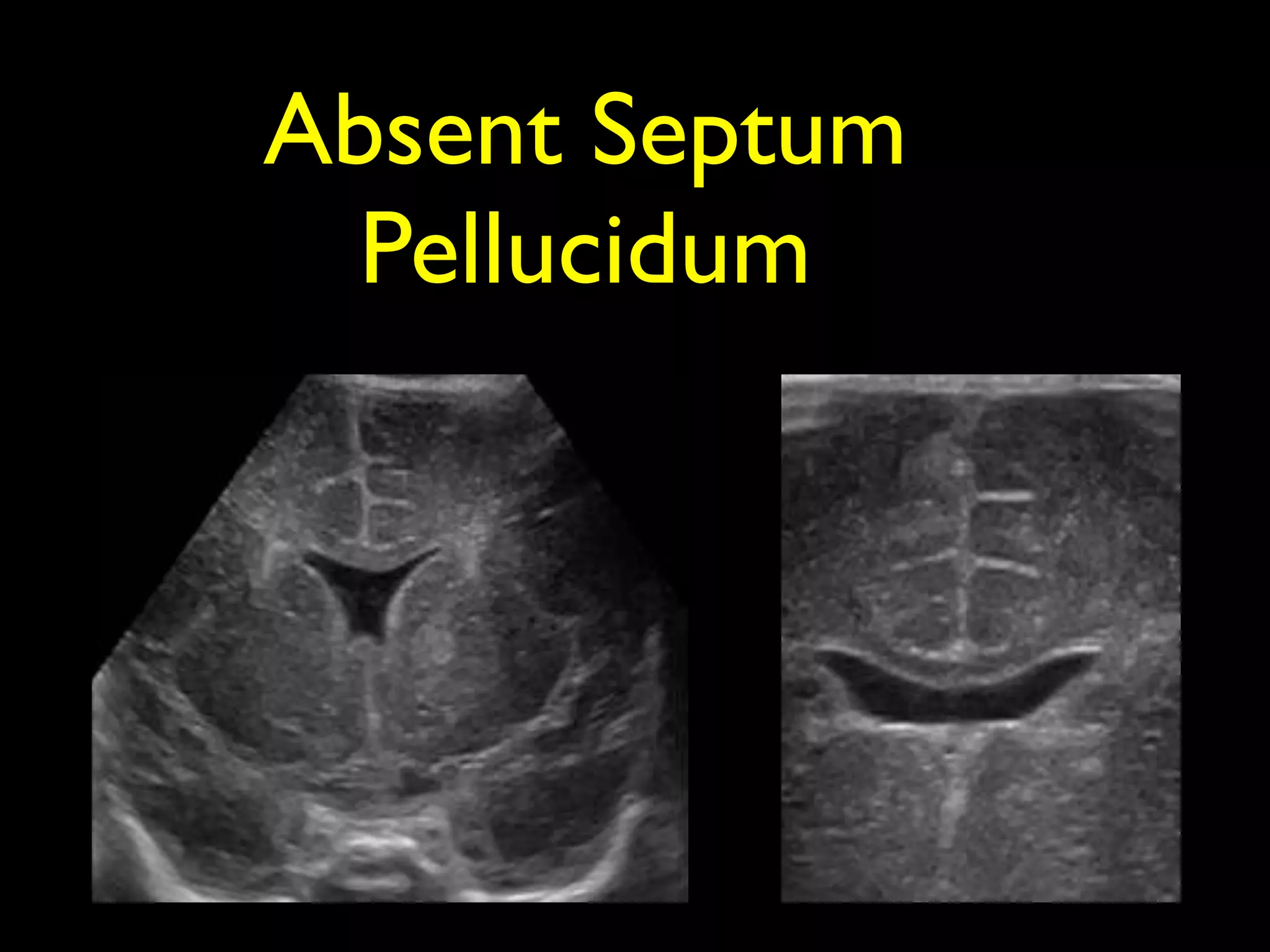 Neonatal Cranial & Spinal Ultrasound | PDF | Brain and Nervous System ...