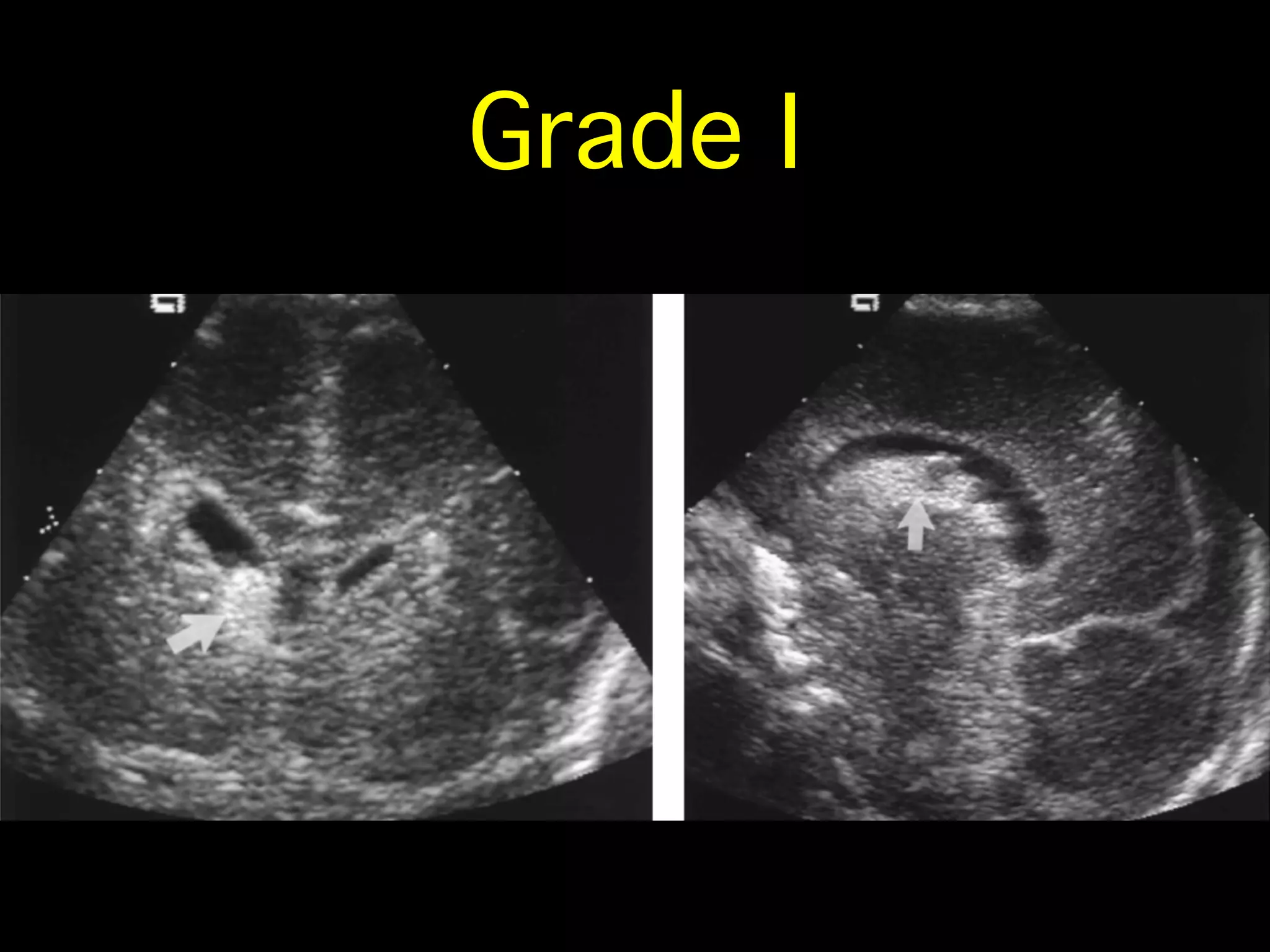 Neonatal Cranial & Spinal Ultrasound | PDF