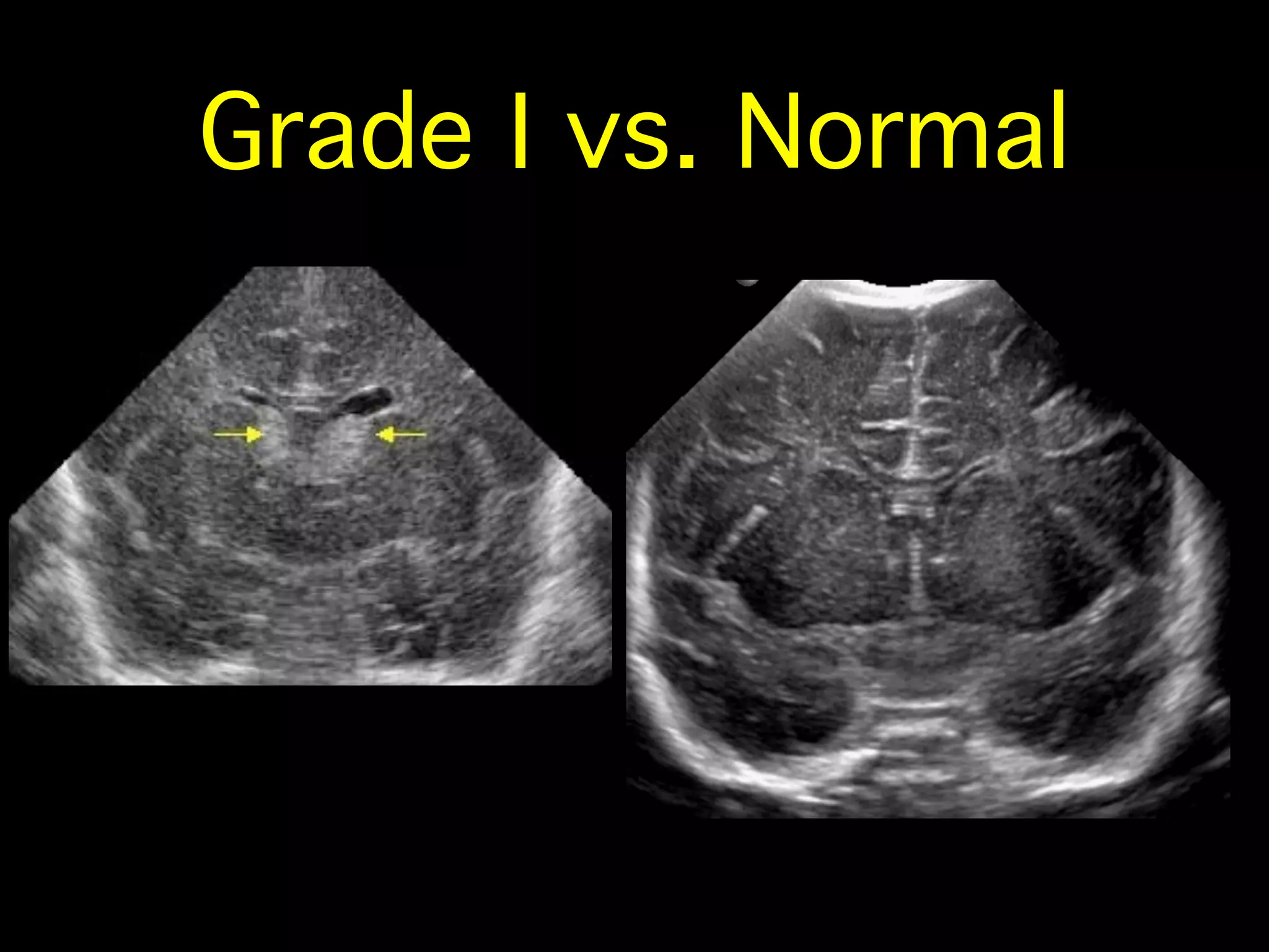 Neonatal Cranial & Spinal Ultrasound | PDF | Brain and Nervous System ...