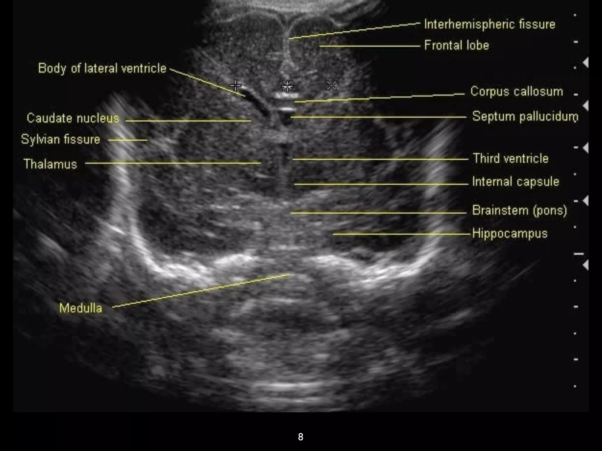 Neonatal Cranial & Spinal Ultrasound | PDF | Brain and Nervous System ...