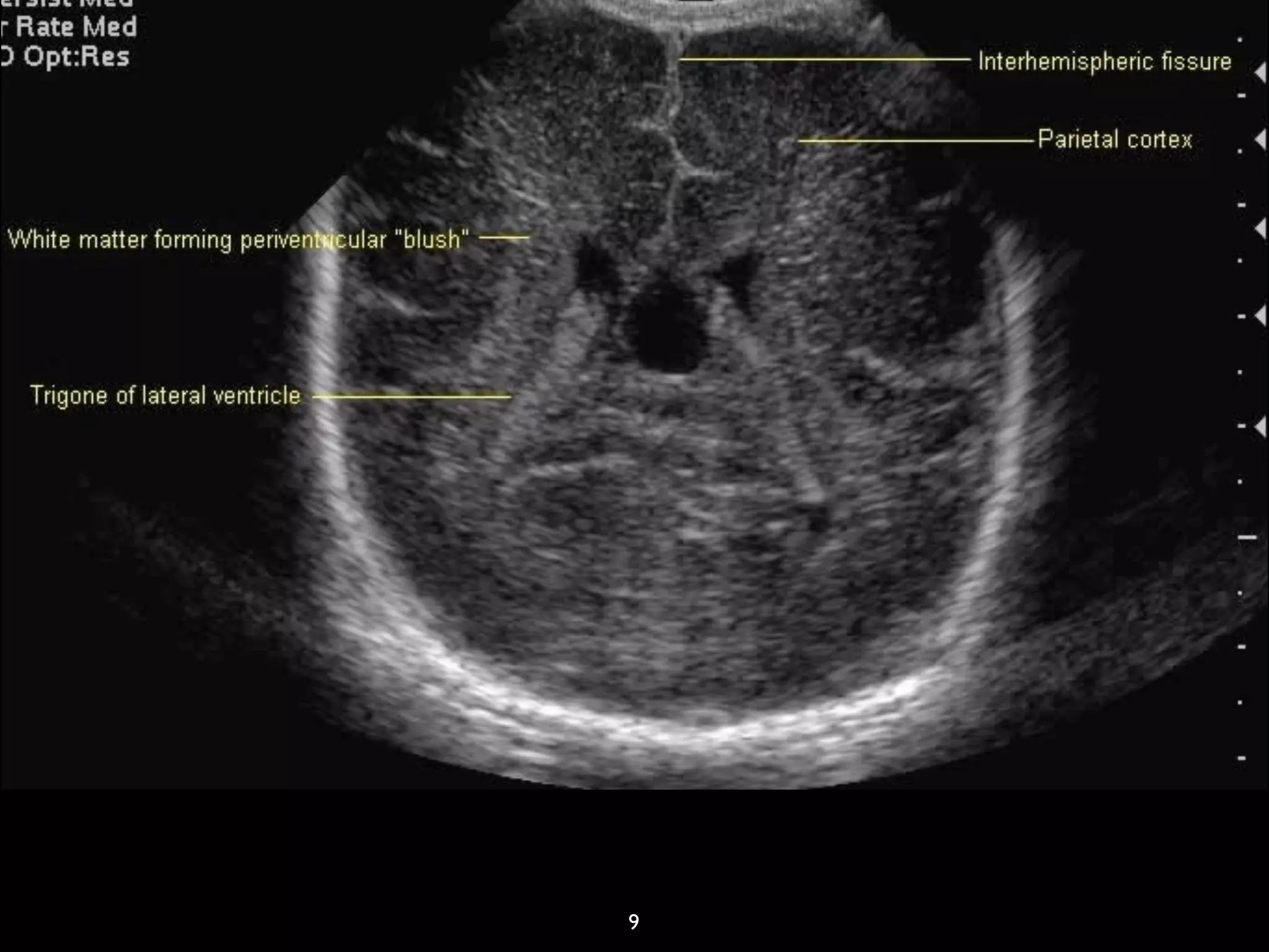 Neonatal Cranial & Spinal Ultrasound | PDF