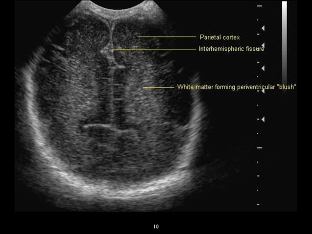 Neonatal Cranial & Spinal Ultrasound | PDF | Brain and Nervous System ...
