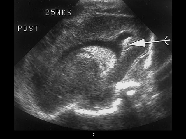 Neonatal Cranial & Spinal Ultrasound | PDF | Brain and Nervous System ...